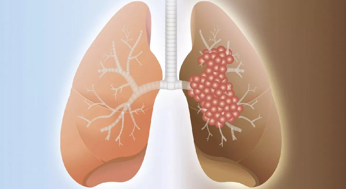 Idiopathic Pulmonary Fibrosis: Symptoms & Treatment | Aster RV Bangalore